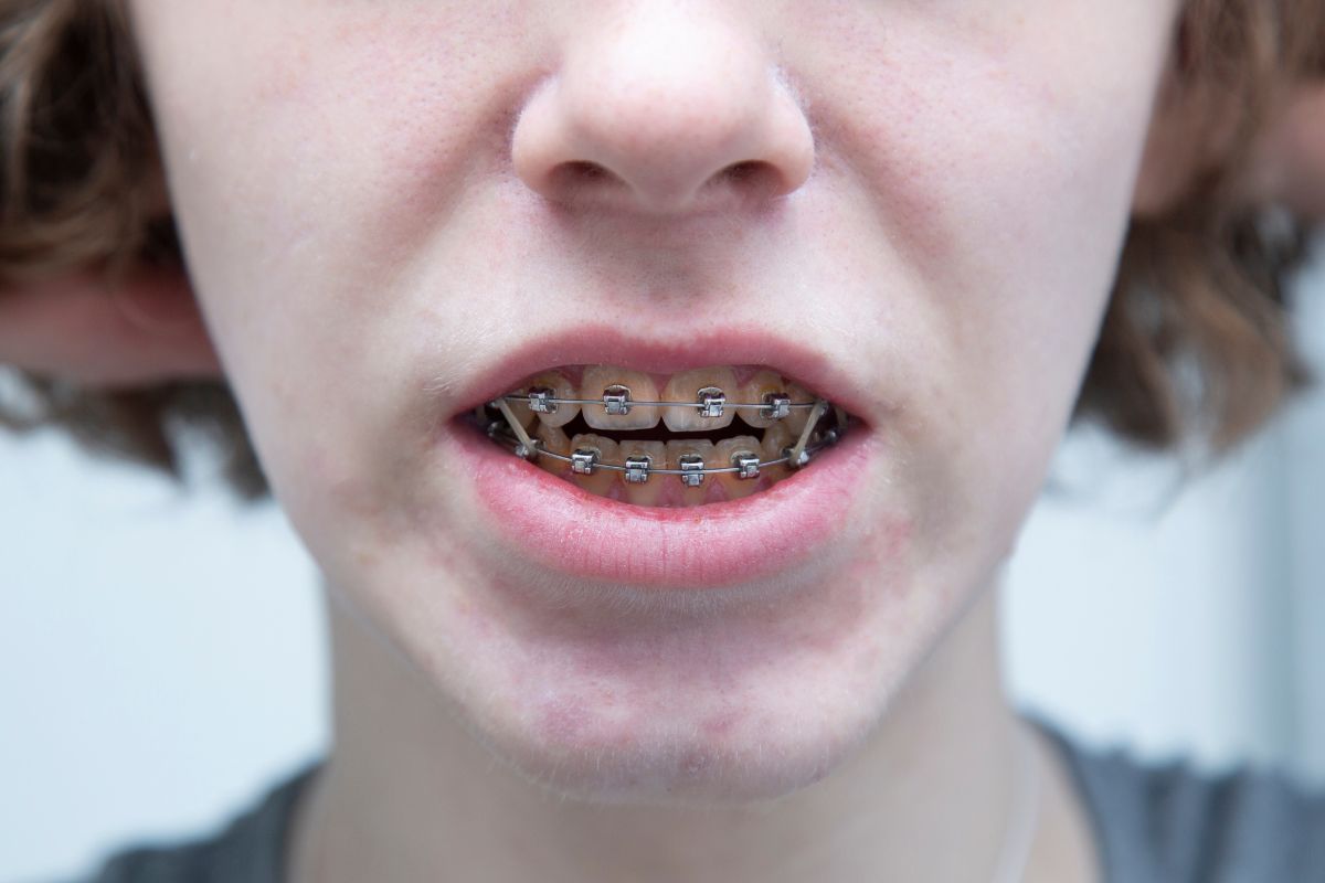 Orthodontic Fixes For Open Bite Issues